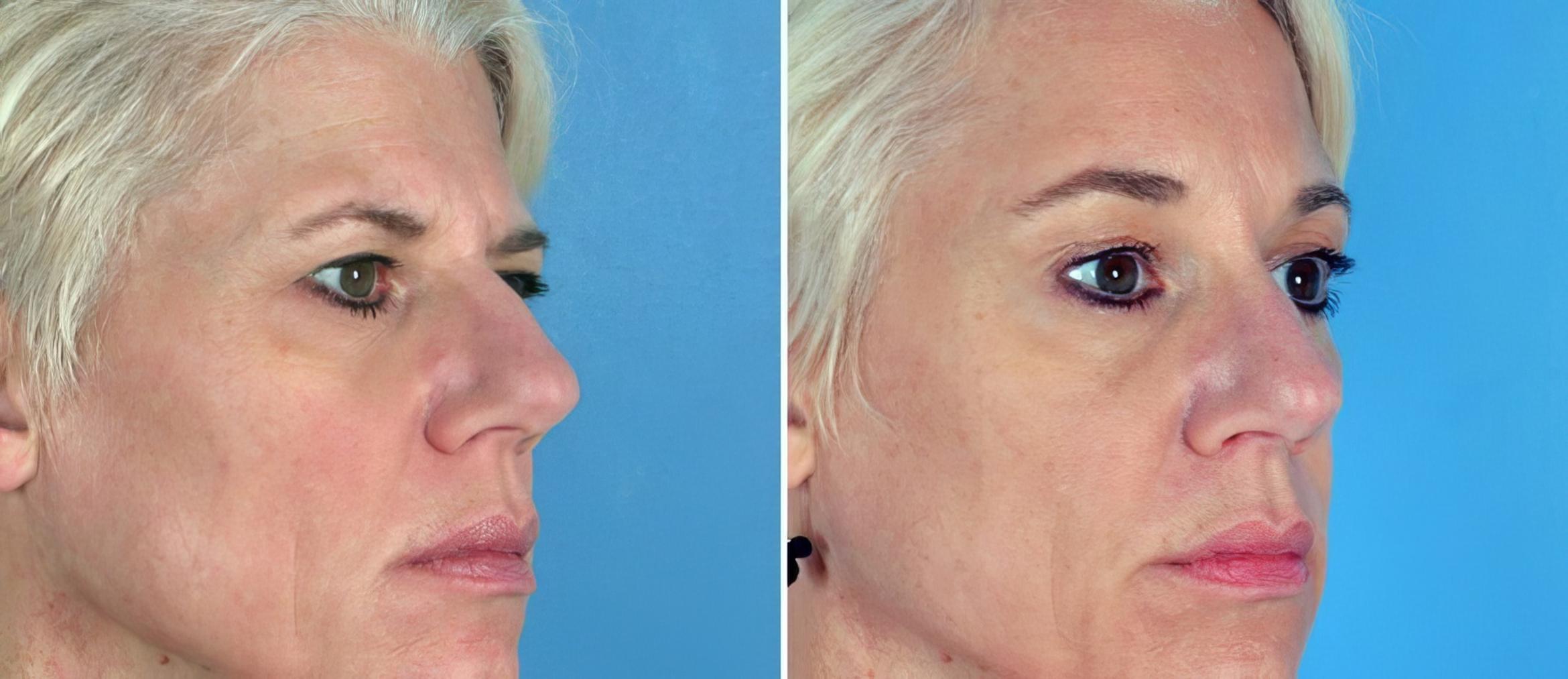 Brow Lift Before And After Pictures Case 17459 Alpharetta Ga The Swan Center For Plastic