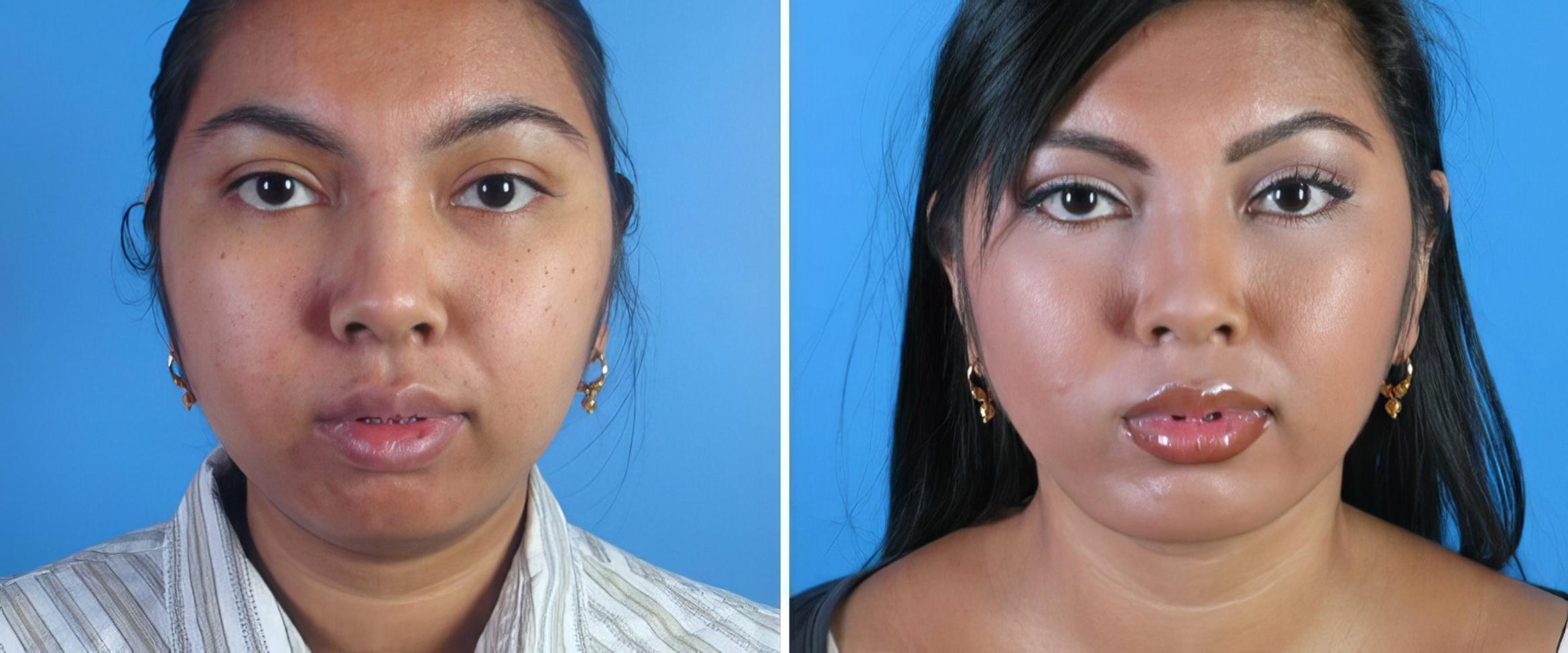 Chin Augmentation / Neck Lift Before and After Pictures Case 18148 ...