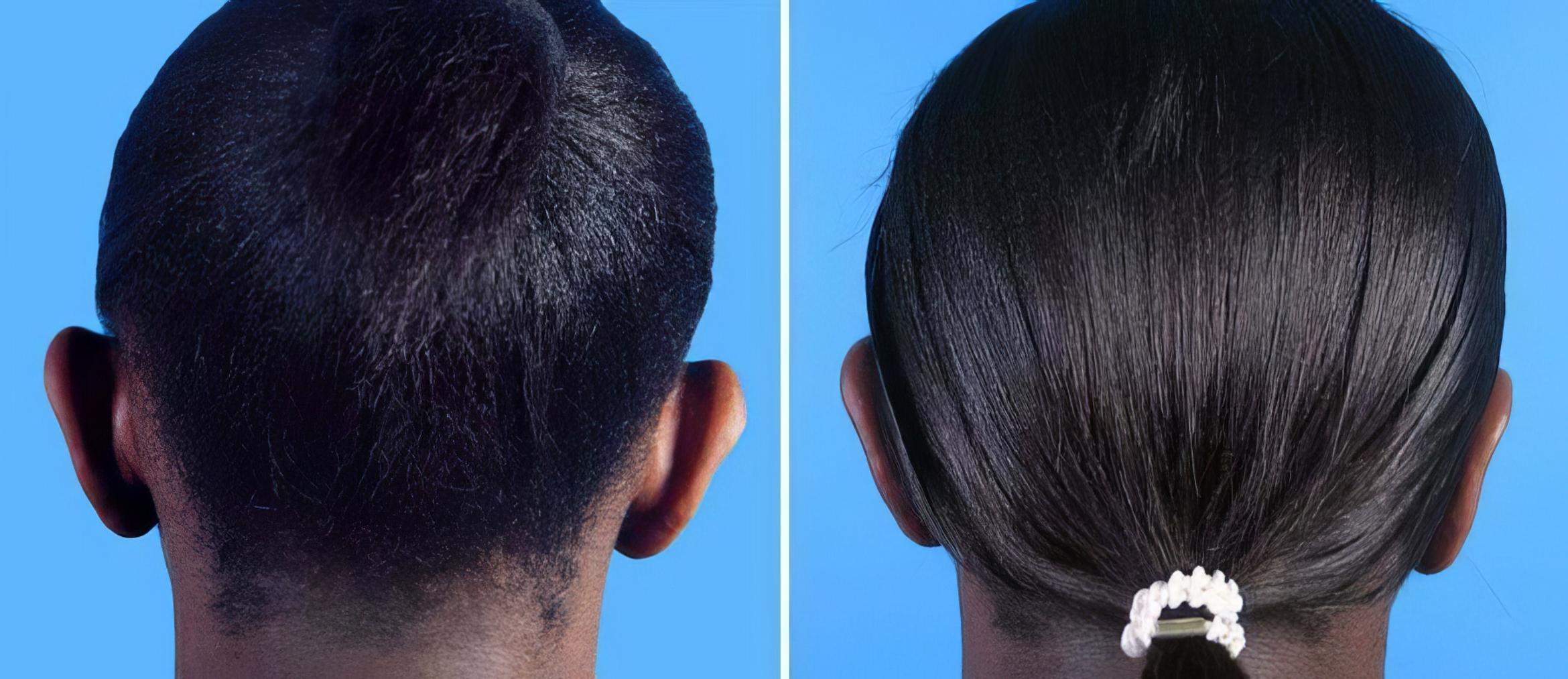 Ear Reshaping Before and After Pictures Case 17471 | Atlanta, GA | The ...