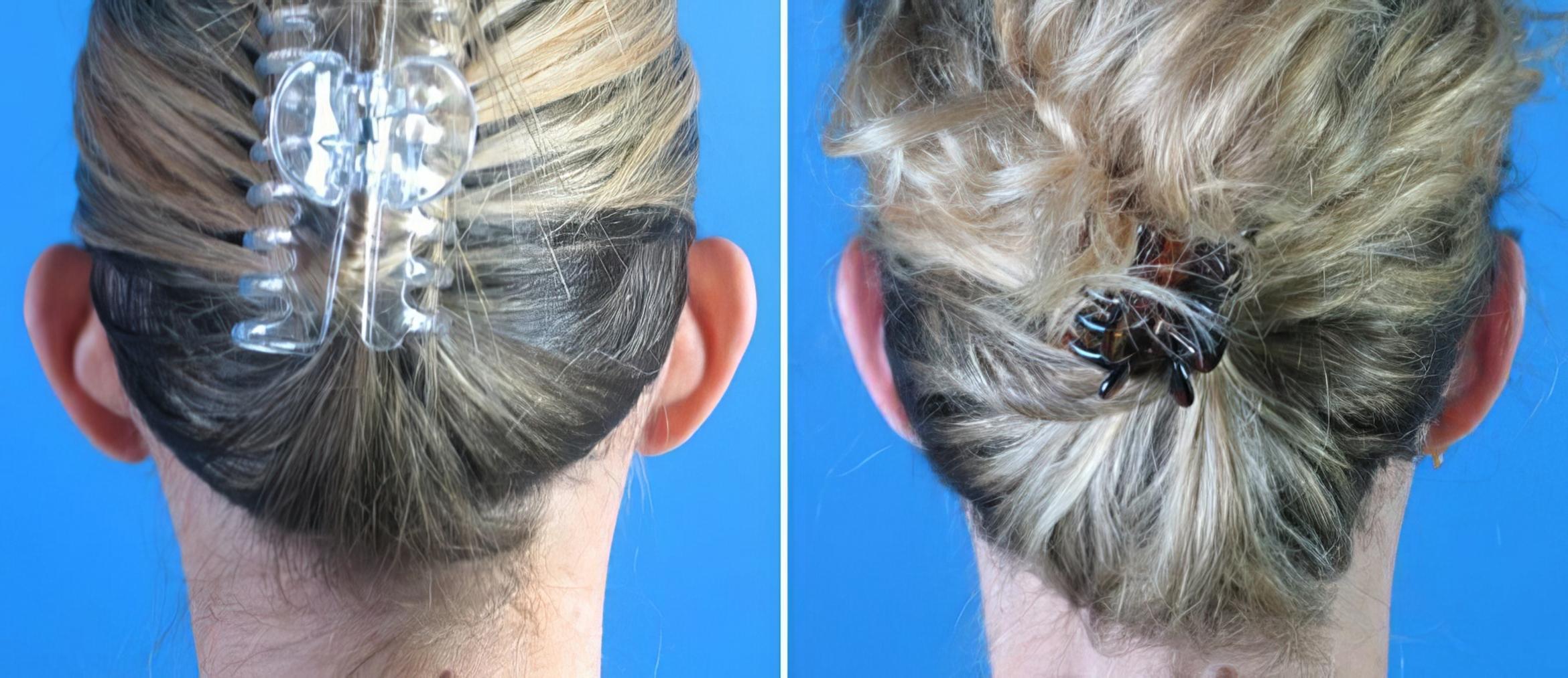 Ear Reshaping Before and After Pictures Case 18166 | Atlanta, GA | The ...