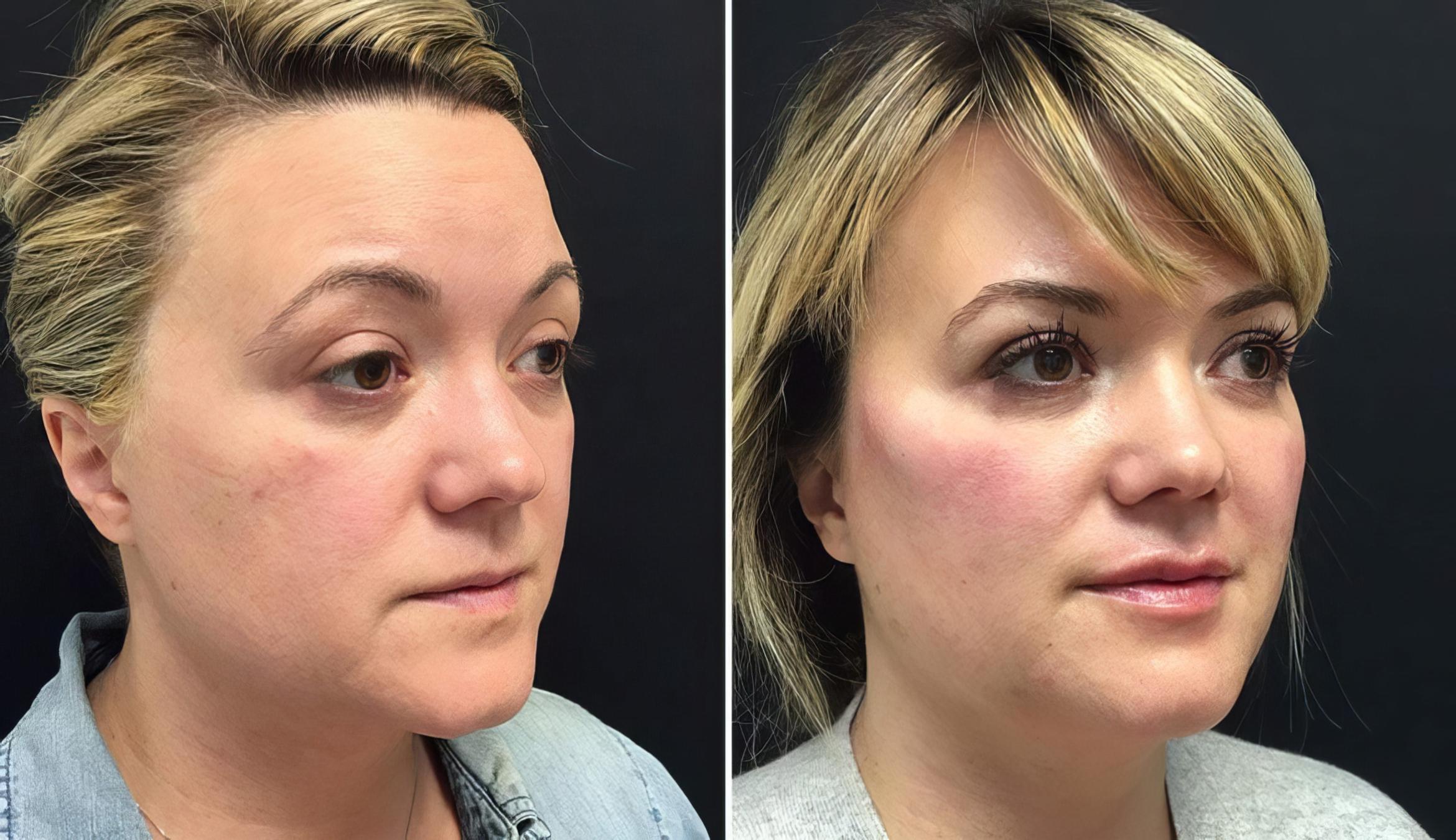 Injectables & Fillers Before and After Pictures Case 26682 | Atlanta ...