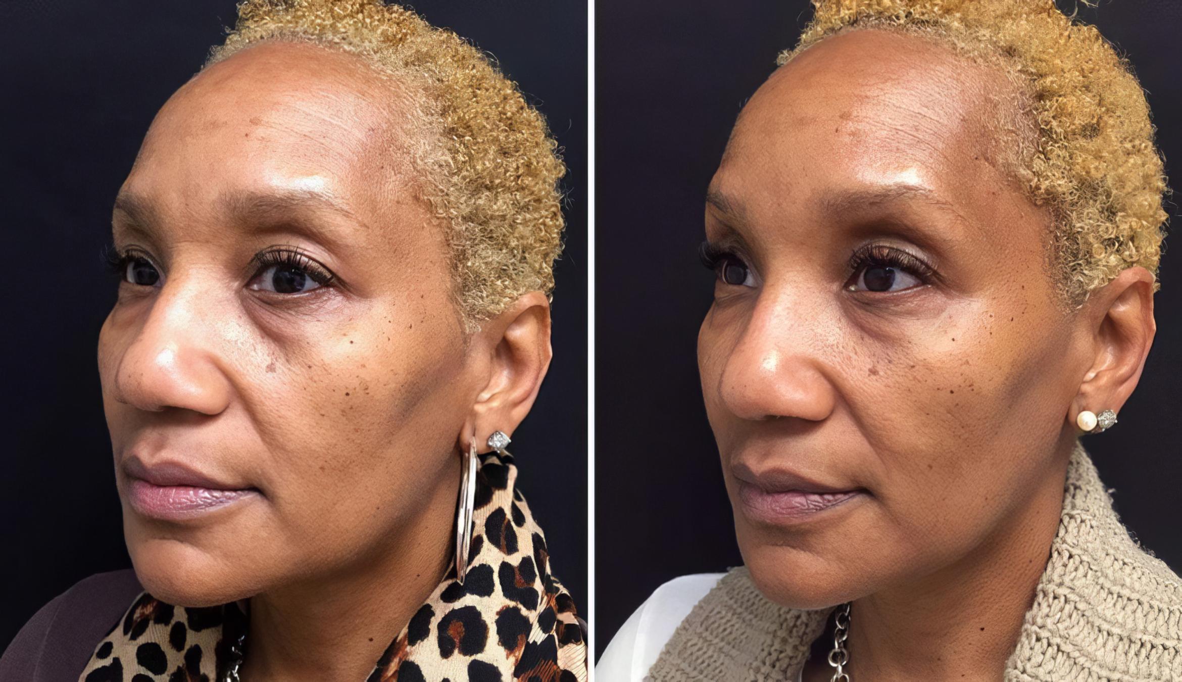 Injectables & Fillers Before and After Pictures Case 28299 | Atlanta ...