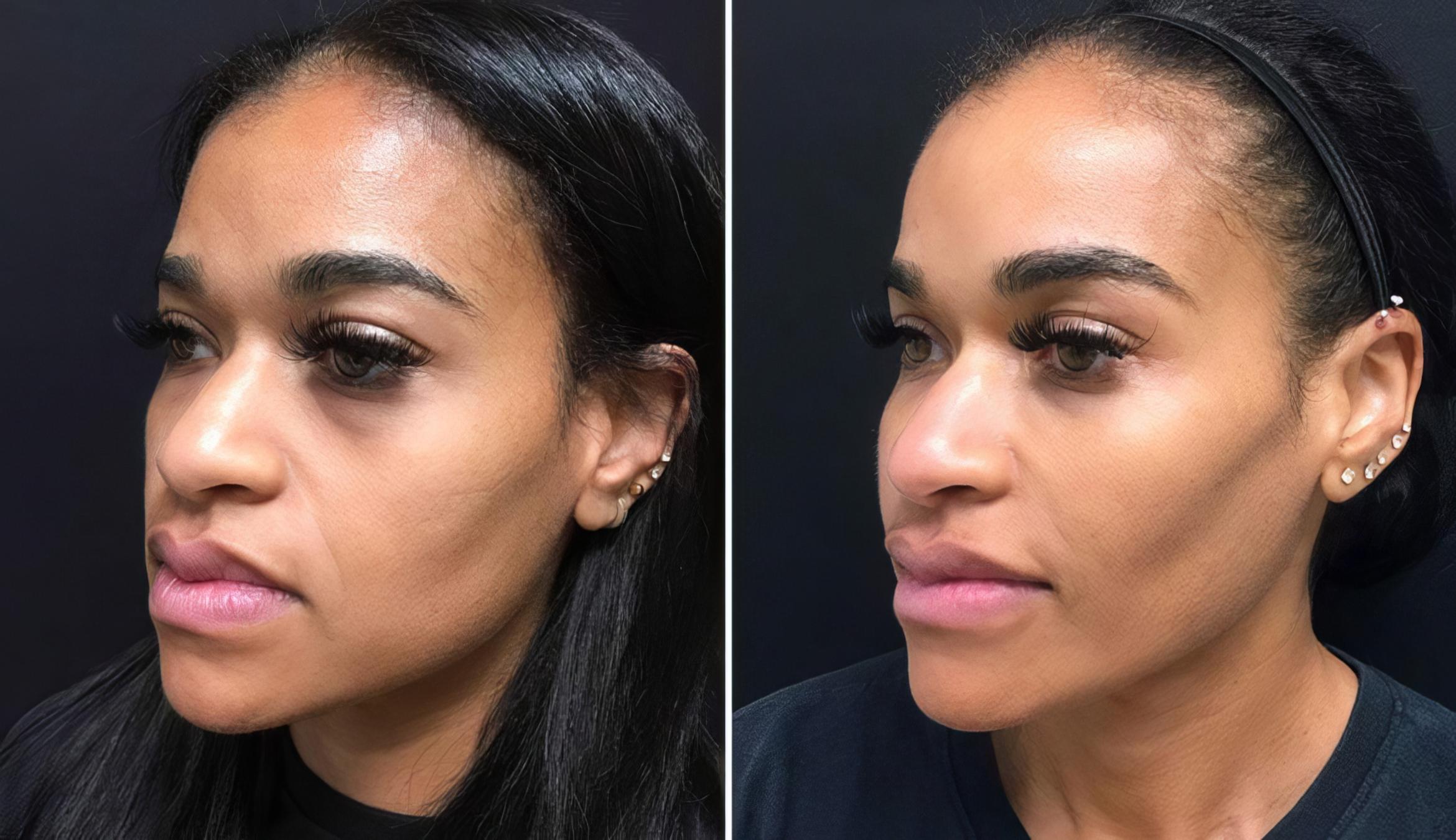 Injectables & Fillers Before and After Pictures Case 28305 | Atlanta ...